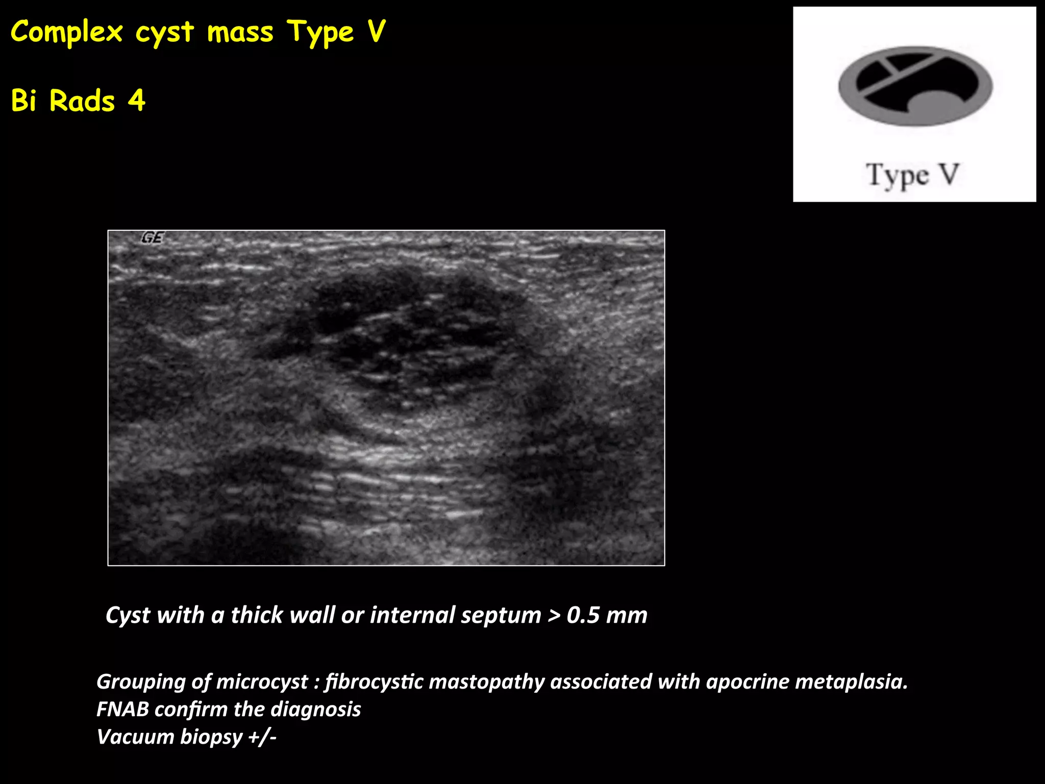 Jy seror breast cyst benign or malignant jfim hanoi 2015 | PDF