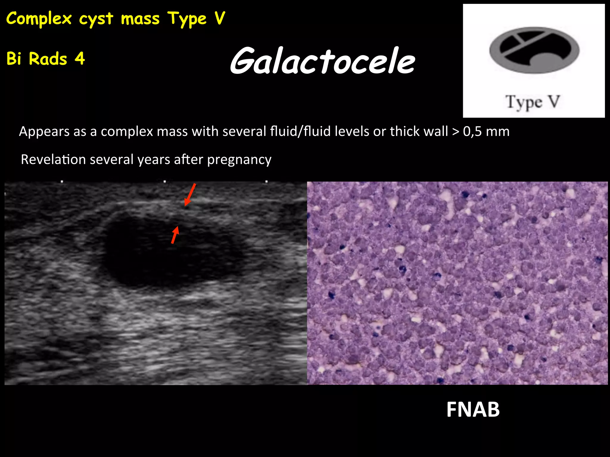 Jy seror breast cyst benign or malignant jfim hanoi 2015 | PDF
