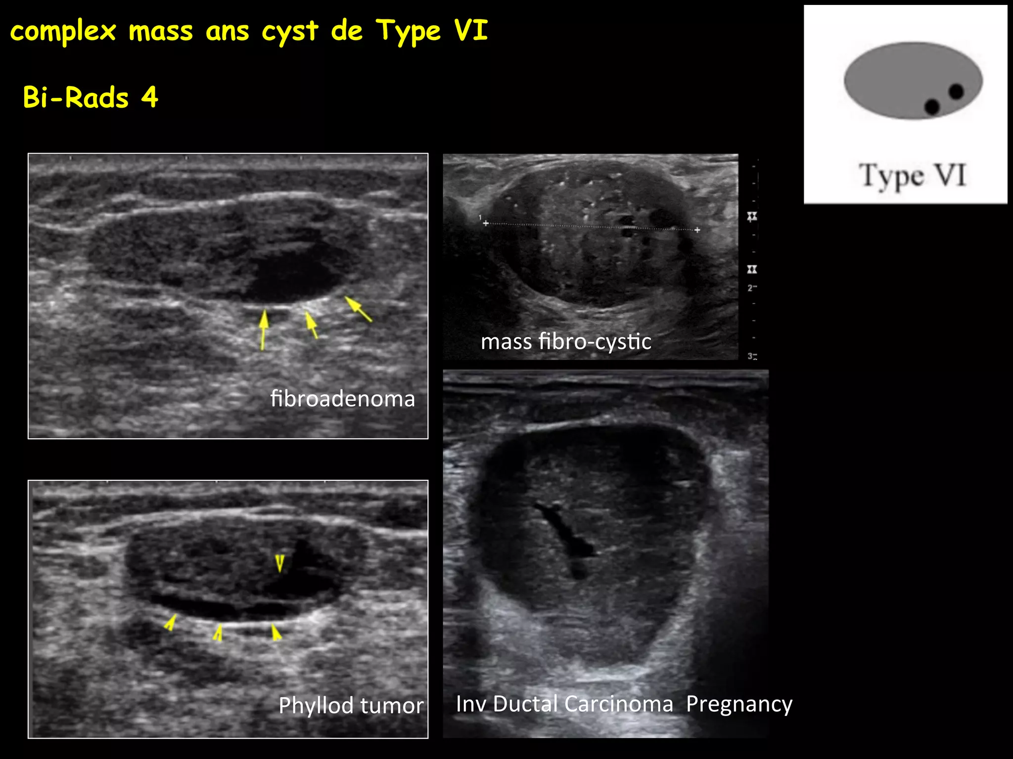 Jy seror breast cyst benign or malignant jfim hanoi 2015 | PDF