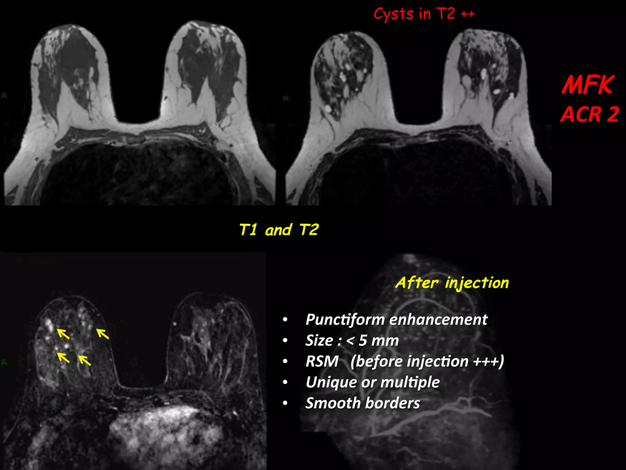Jy seror breast cyst benign or malignant jfim hanoi 2015 | PDF