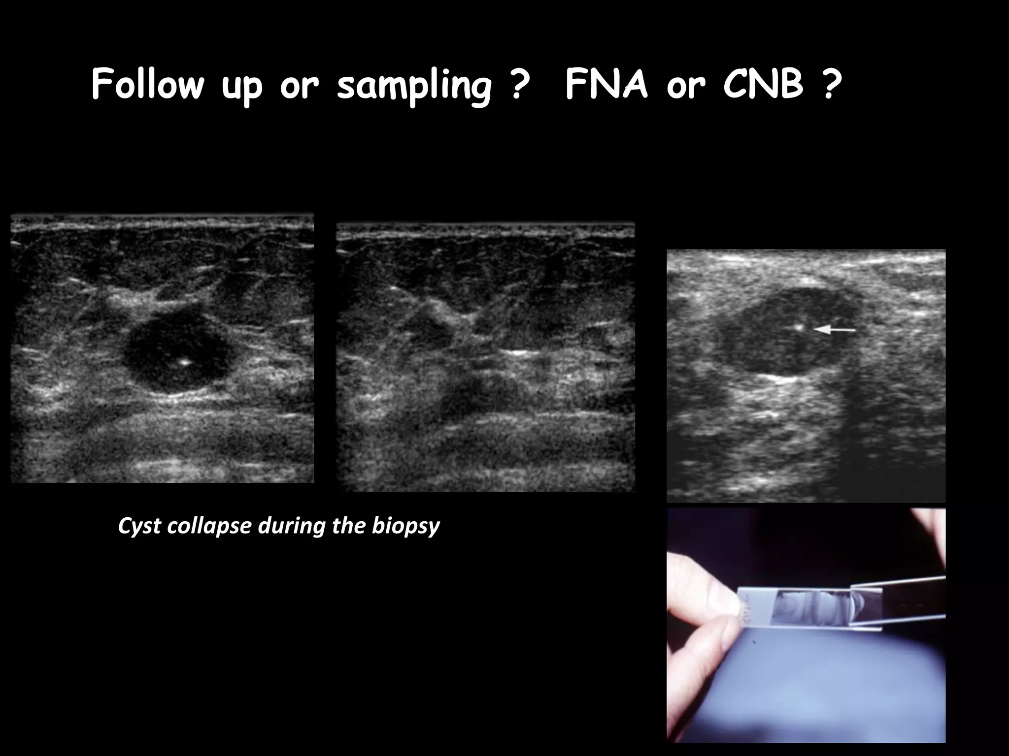 Jy seror breast cyst benign or malignant jfim hanoi 2015 | PDF