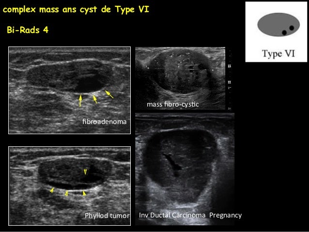 Jy seror breast cyst benign or malignant jfim hanoi 2015