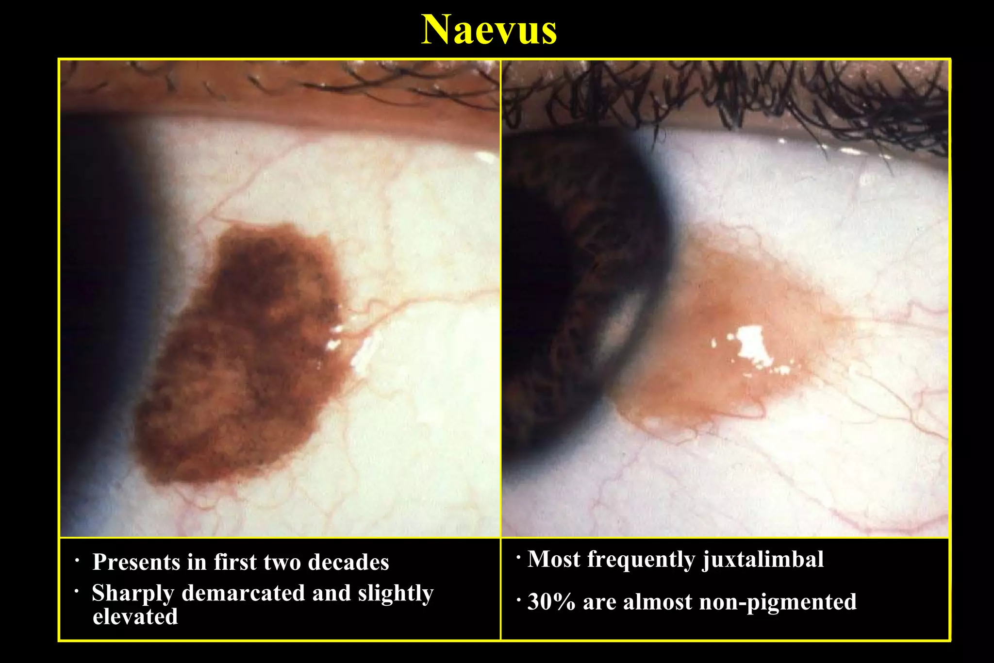 12 conjunctival tumours | PPT