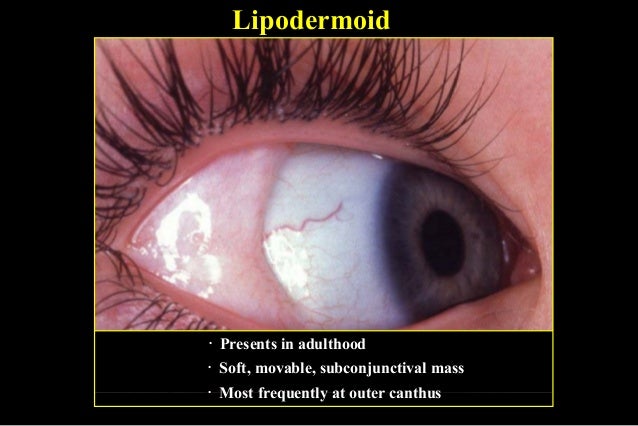 12 conjunctival tumours