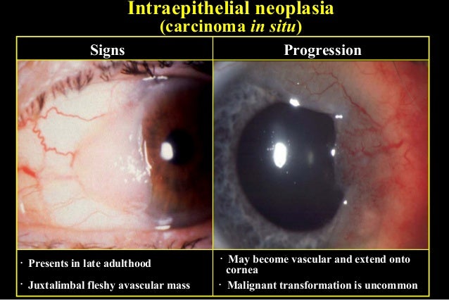 12 conjunctival tumours
