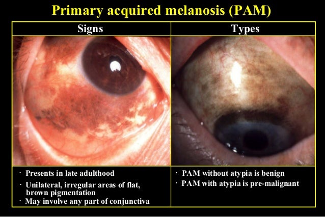 12 conjunctival tumours