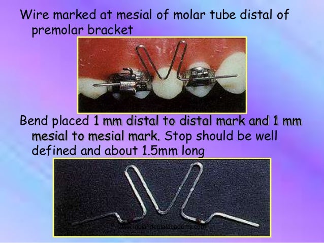 K loop /certified fixed orthodontic courses by Indian dental academy