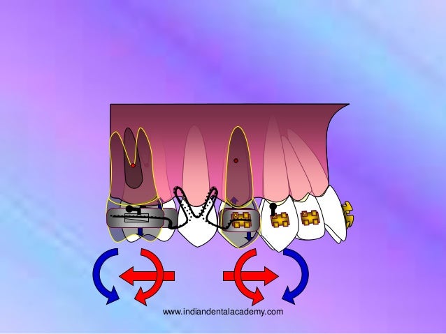 K loop /certified fixed orthodontic courses by Indian dental academy