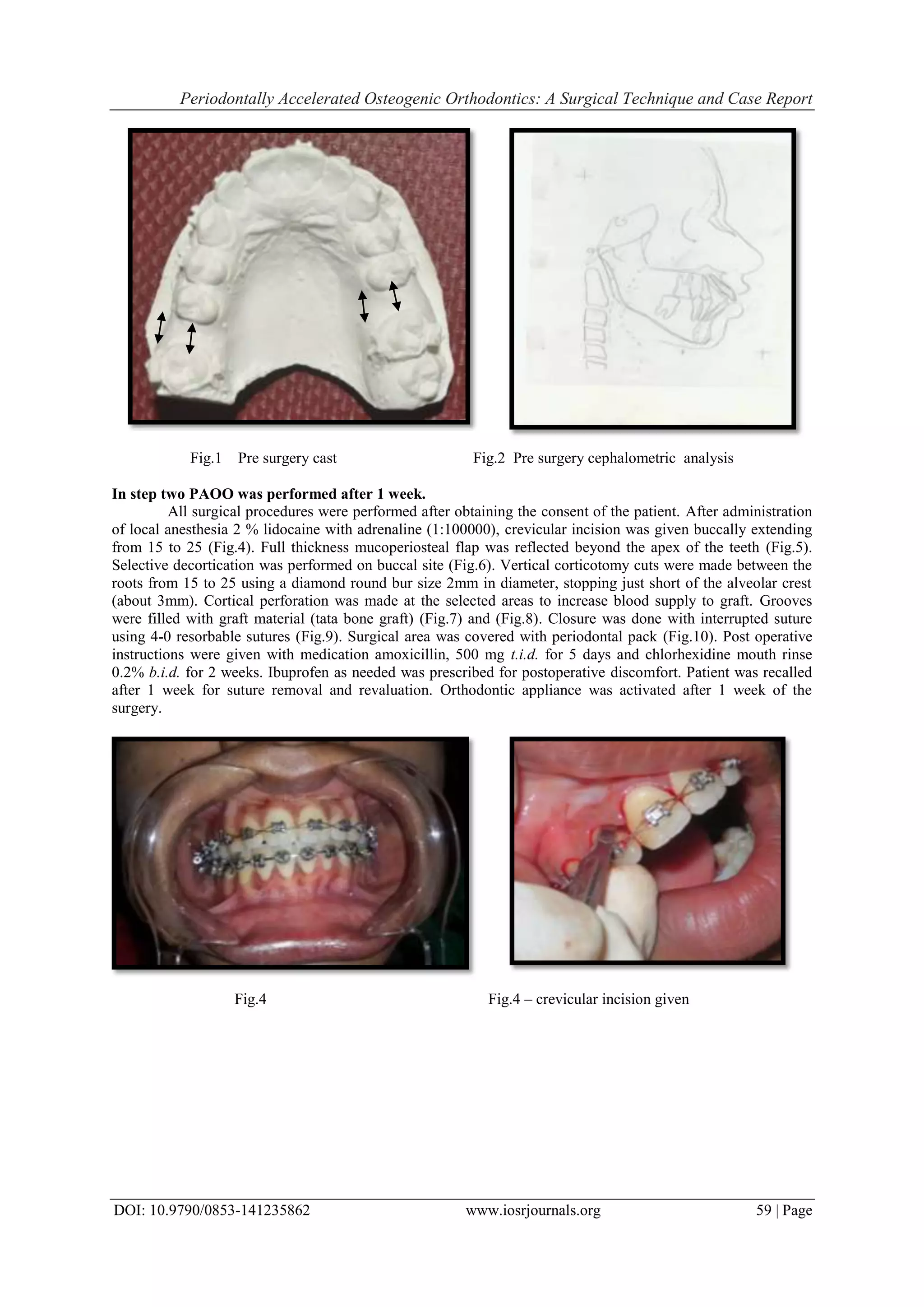 Periodontally Accelerated Osteogenic Orthodontics: A Surgical Technique and Case Report | PDF