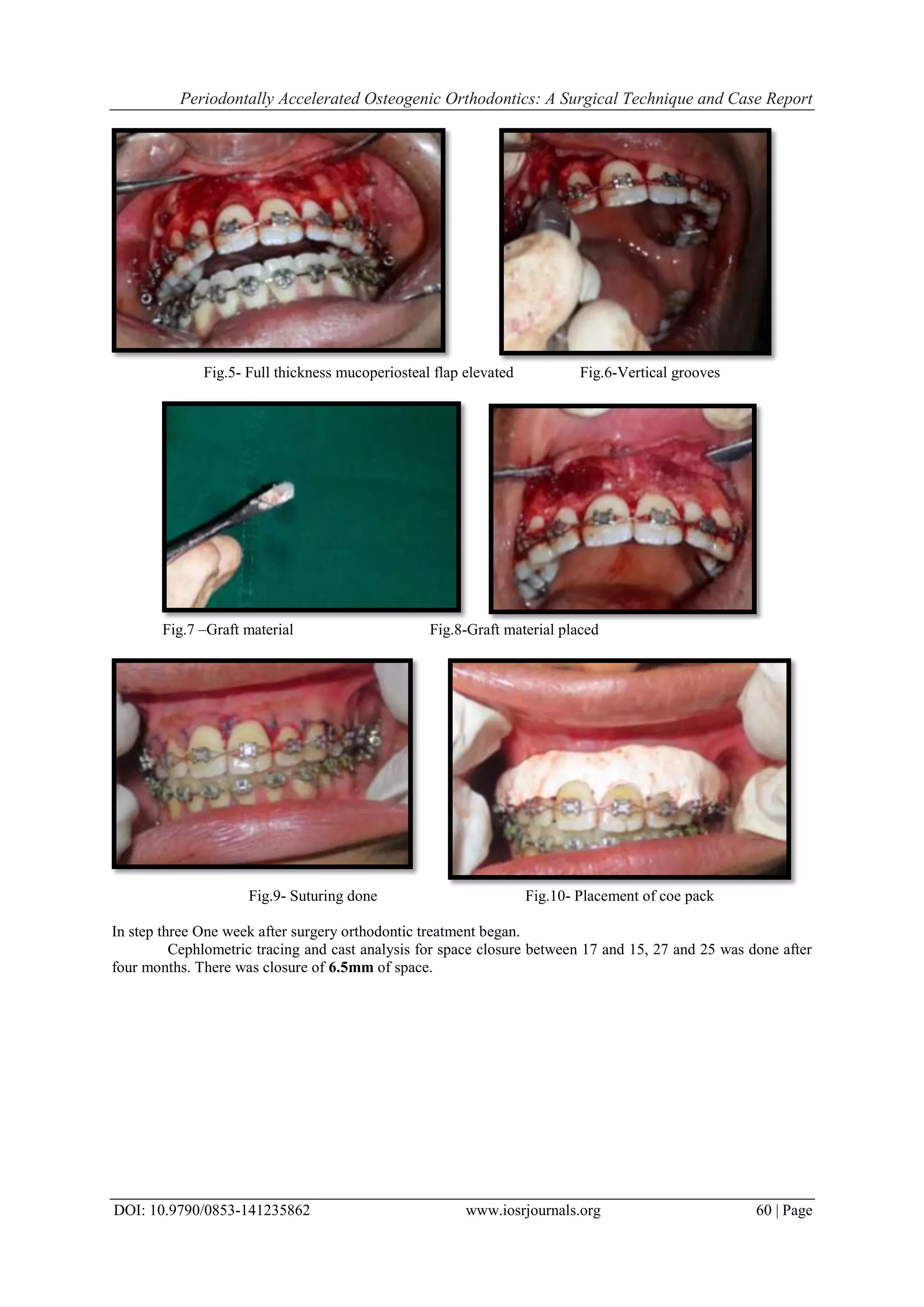 Periodontally Accelerated Osteogenic Orthodontics: A Surgical Technique ...