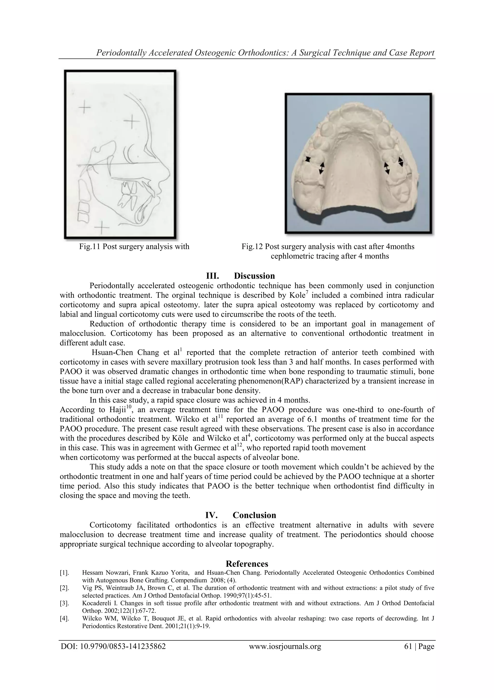 Periodontally Accelerated Osteogenic Orthodontics: A Surgical Technique and Case Report | PDF