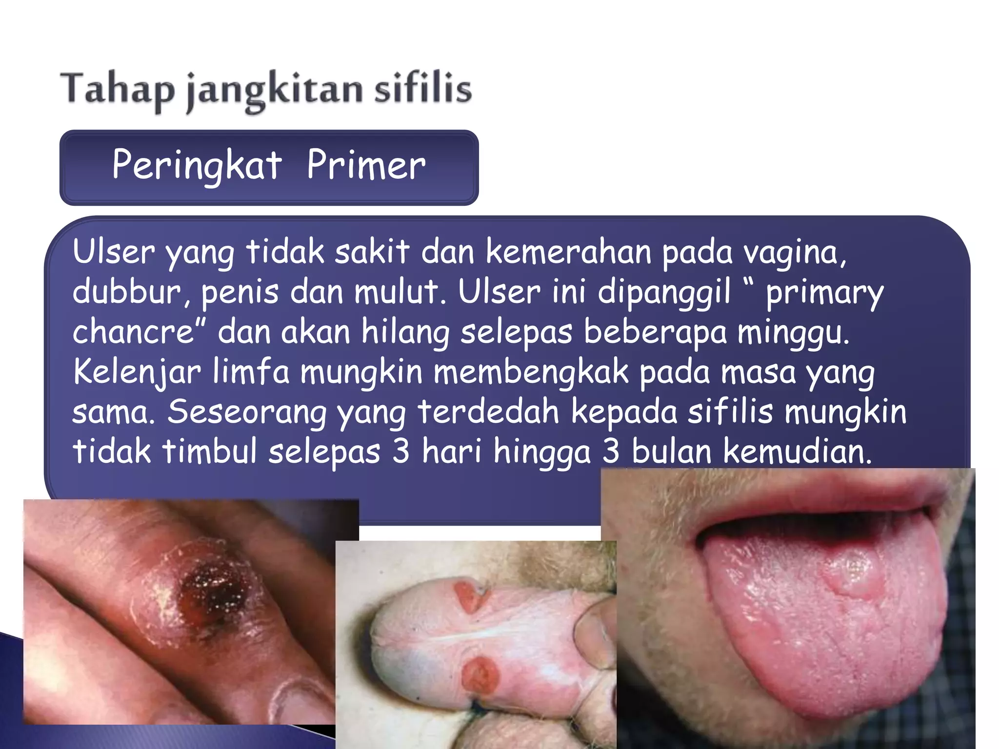 Syphilis aka Sifilis - Komunikasi Kesihatan | PPTX