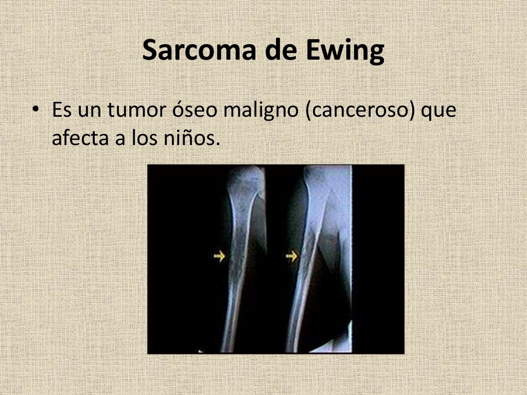 Sarcoma de Ewing