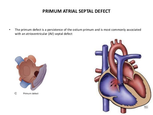 Atrial septal defect DR NIKUNJ R SHEKHADA (MBBS,MS GEN SURG,DNB CTS SR