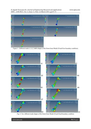 Natural Vibration Analysis of Femur Bone Using Hyperworks | PDF
