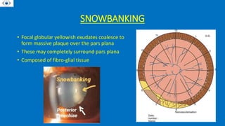 INTERMEDIATE_UVEITIS presentation dhir hospital bhiwani.pptx