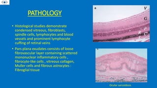 INTERMEDIATE_UVEITIS presentation dhir hospital bhiwani.pptx