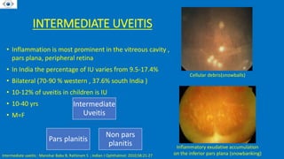 INTERMEDIATE_UVEITIS presentation dhir hospital bhiwani.pptx