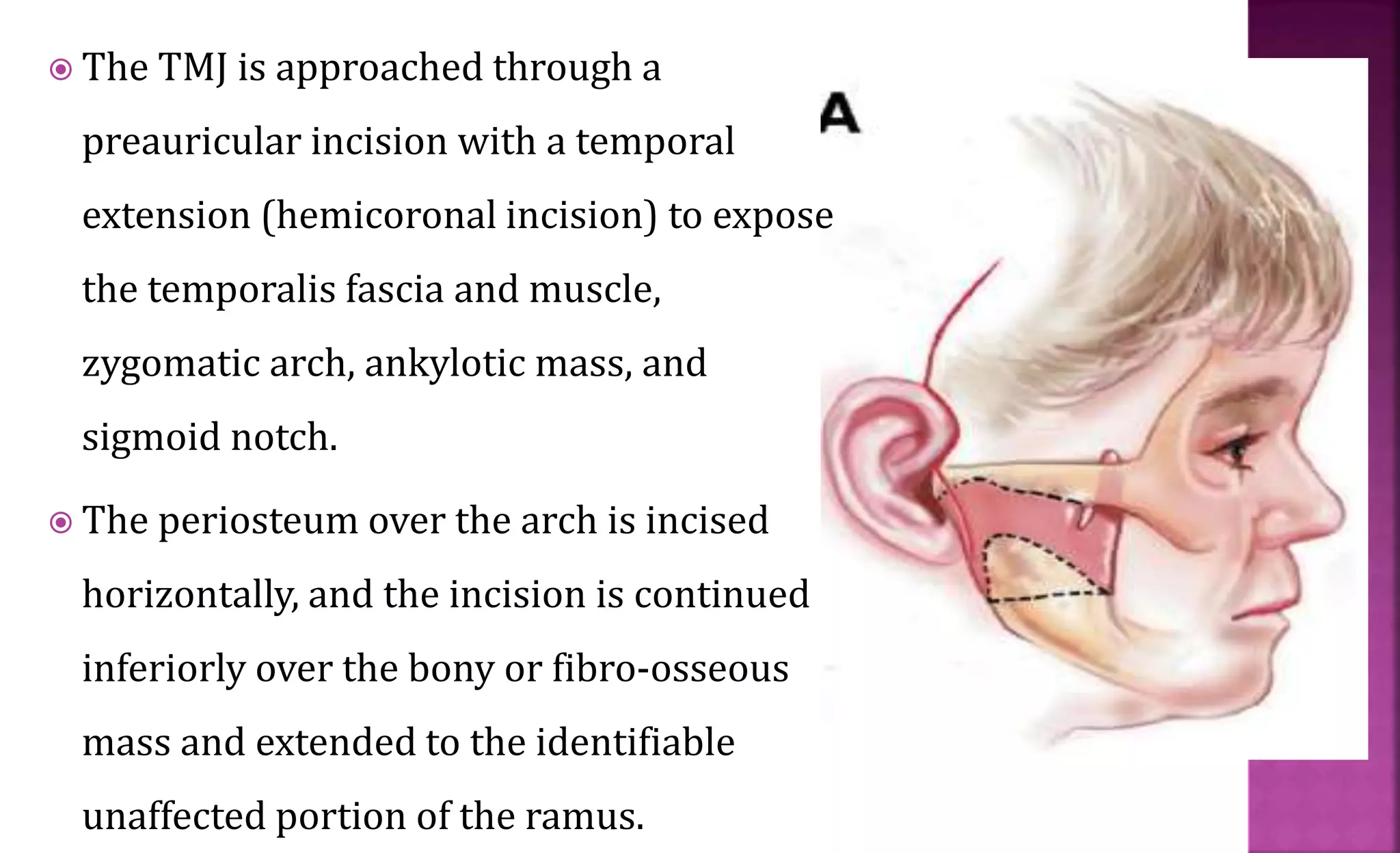 Kaban protocol tmj ankylosis treatment new 2009 | PPTX