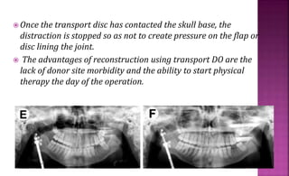 Kaban protocol tmj ankylosis treatment new 2009 | PPTX