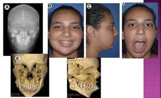 Kaban protocol tmj ankylosis treatment new 2009 | PPTX