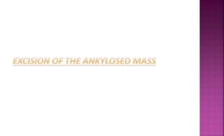 Kaban protocol tmj ankylosis treatment new 2009 | PPTX