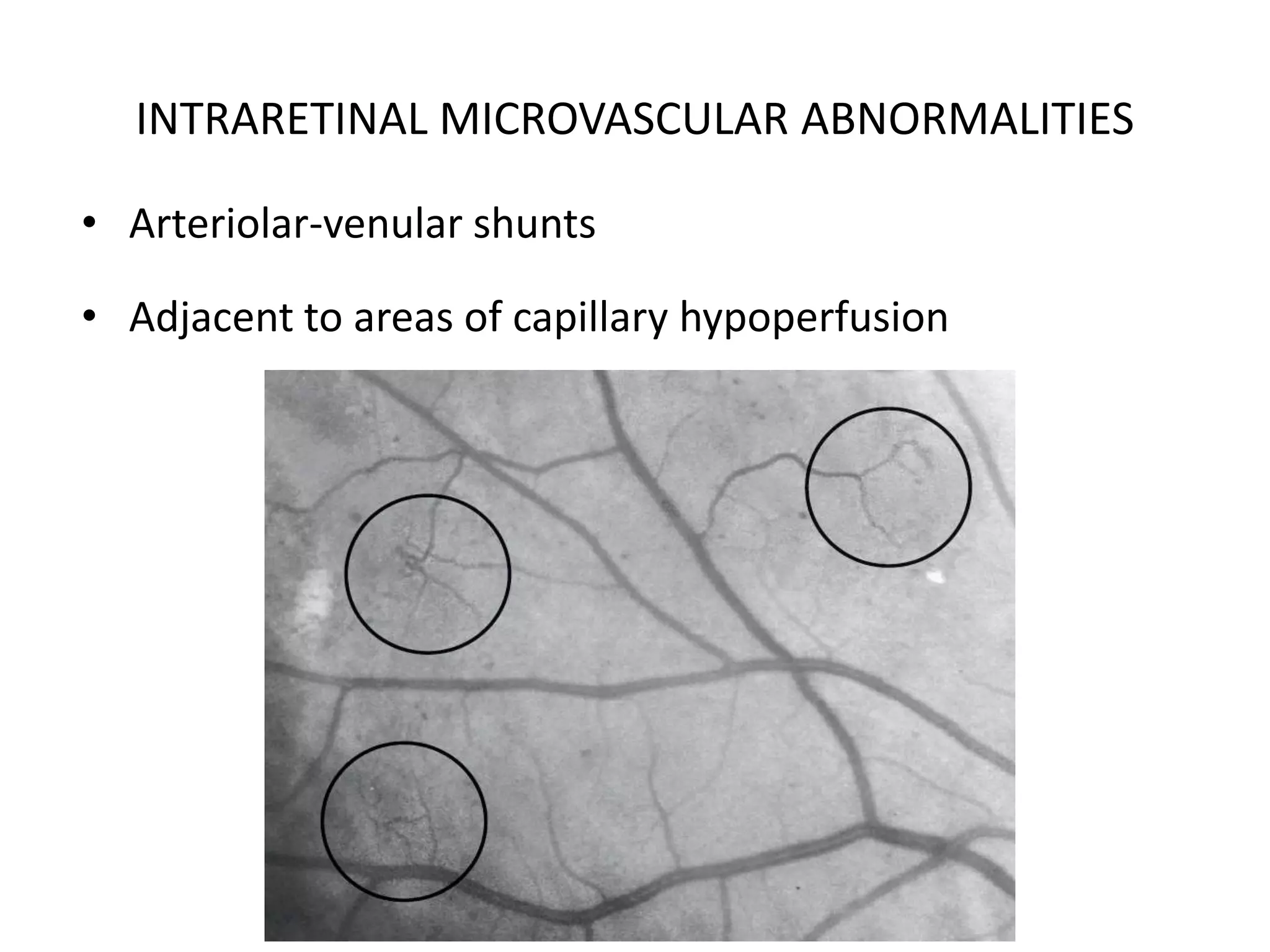 Diabetic Retinopathy (ophthalmology) | PPTX