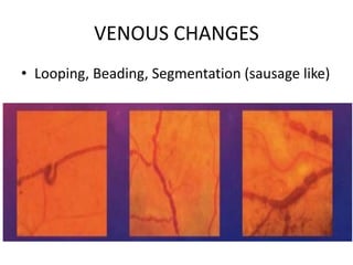 Diabetic Retinopathy (ophthalmology) | PPT