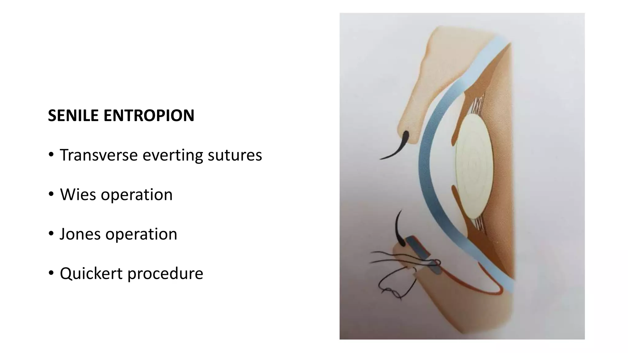 Ectropion and Entropion (Ophthalmology) - Etiology, Management | PPTX
