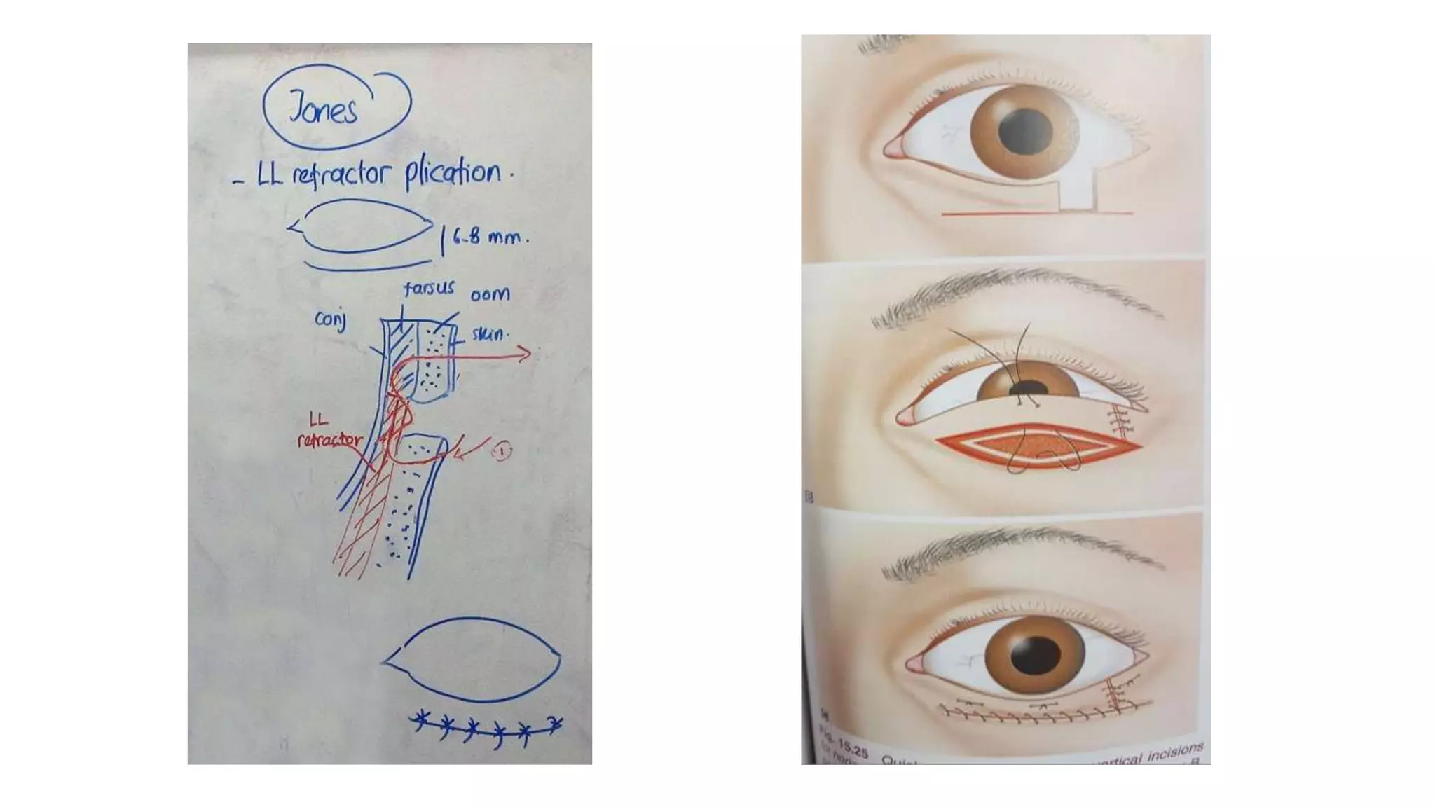 Ectropion and Entropion (Ophthalmology) - Etiology, Management | PPTX