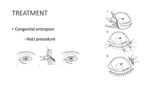 Ectropion and Entropion (Ophthalmology) - Etiology, Management | PPTX