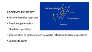 Ectropion and Entropion (Ophthalmology) - Etiology, Management | PPTX