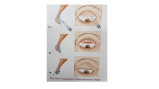 Ectropion and Entropion (Ophthalmology) - Etiology, Management | PPTX