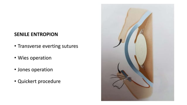 Ectropion and Entropion (Ophthalmology) - Etiology, Management | PPTX