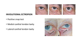 Ectropion and Entropion (Ophthalmology) - Etiology, Management | PPTX