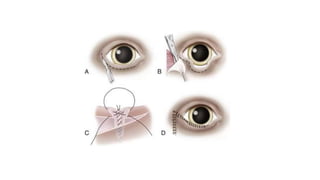Ectropion and Entropion (Ophthalmology) - Etiology, Management | PPTX