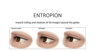 Ectropion and Entropion (Ophthalmology) - Etiology, Management | PPT