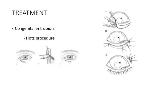 Ectropion and Entropion (Ophthalmology) - Etiology, Management