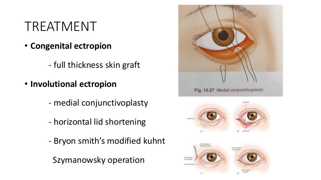 Ectropion and Entropion (Ophthalmology) - Etiology, Management