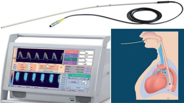 cardiac output monitoring
