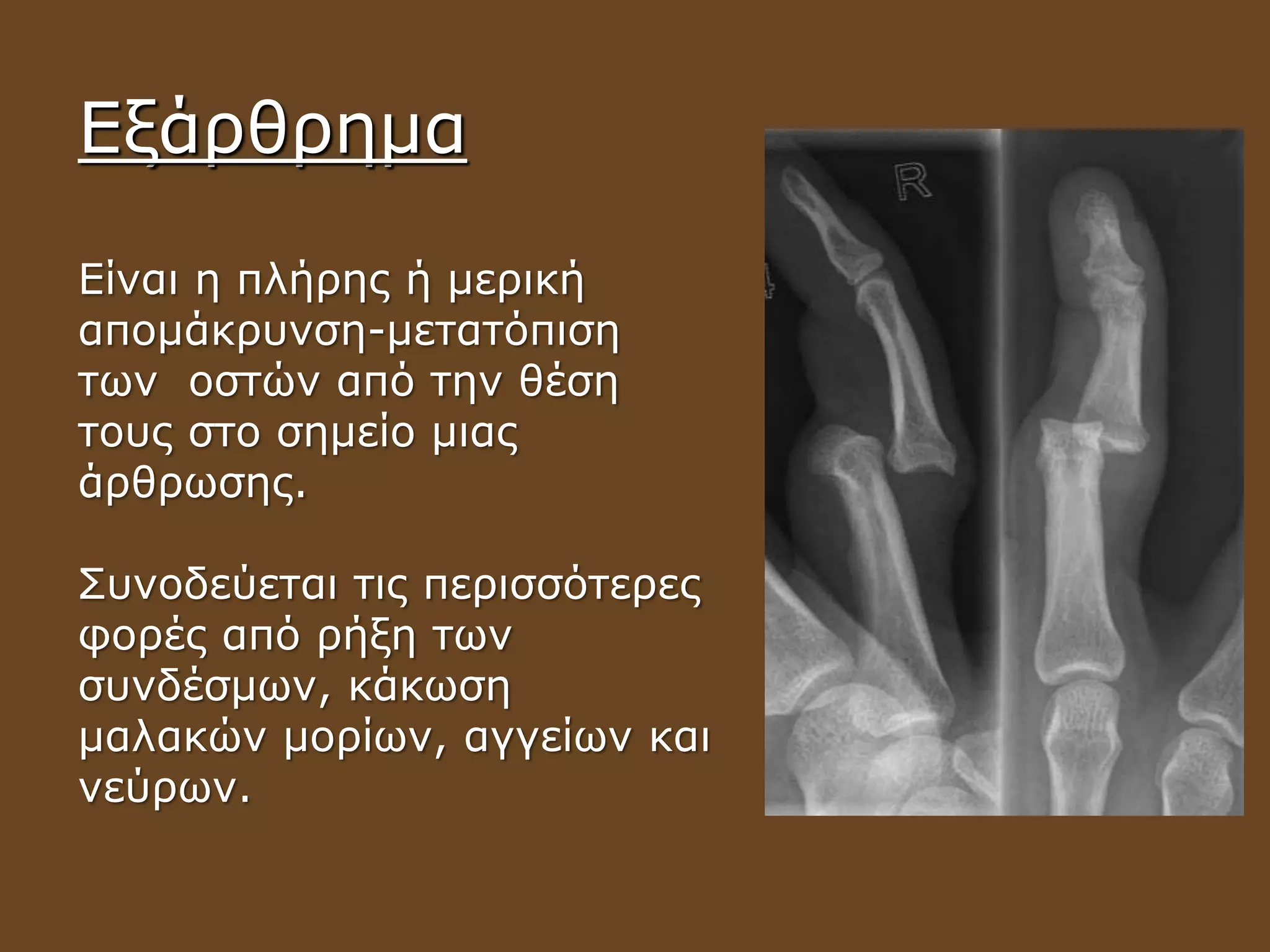 Πρώτες Βοήθειες σε κακώσεις των άκρων | PPT