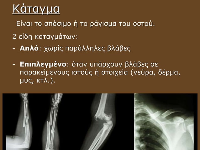 Πρώτες Βοήθειες σε κακώσεις των άκρων | PPT