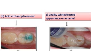 Kalam ppt 1 | PPTX | Dental Health | Diseases and Conditions