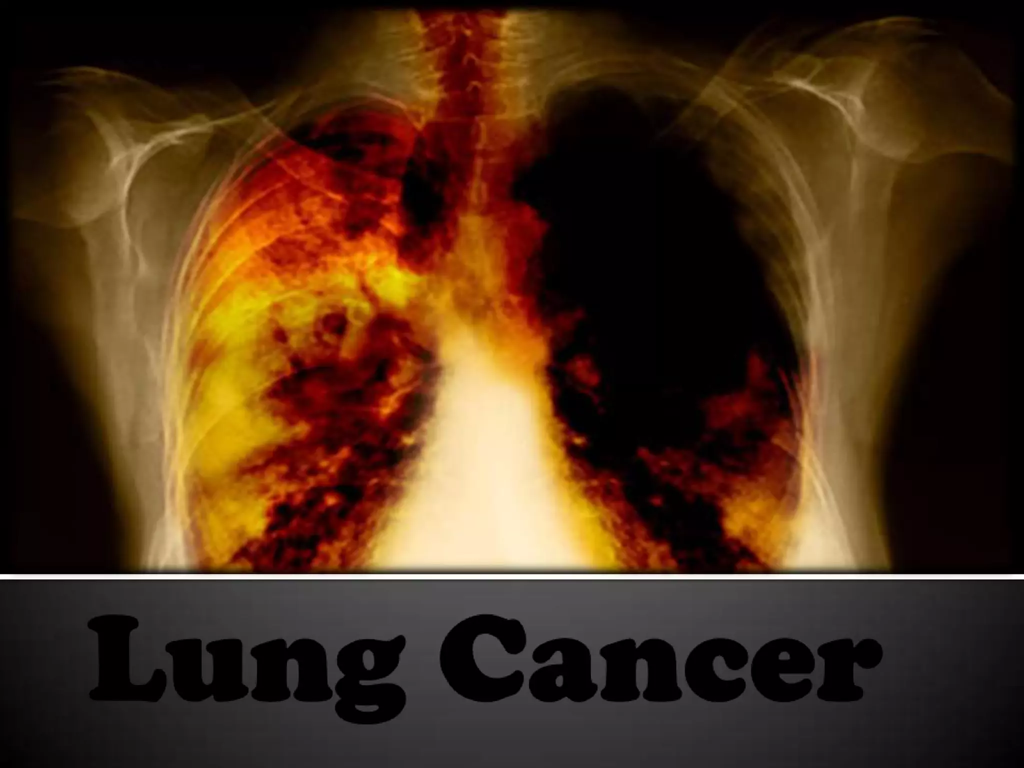 Lung Cancer | PPTX