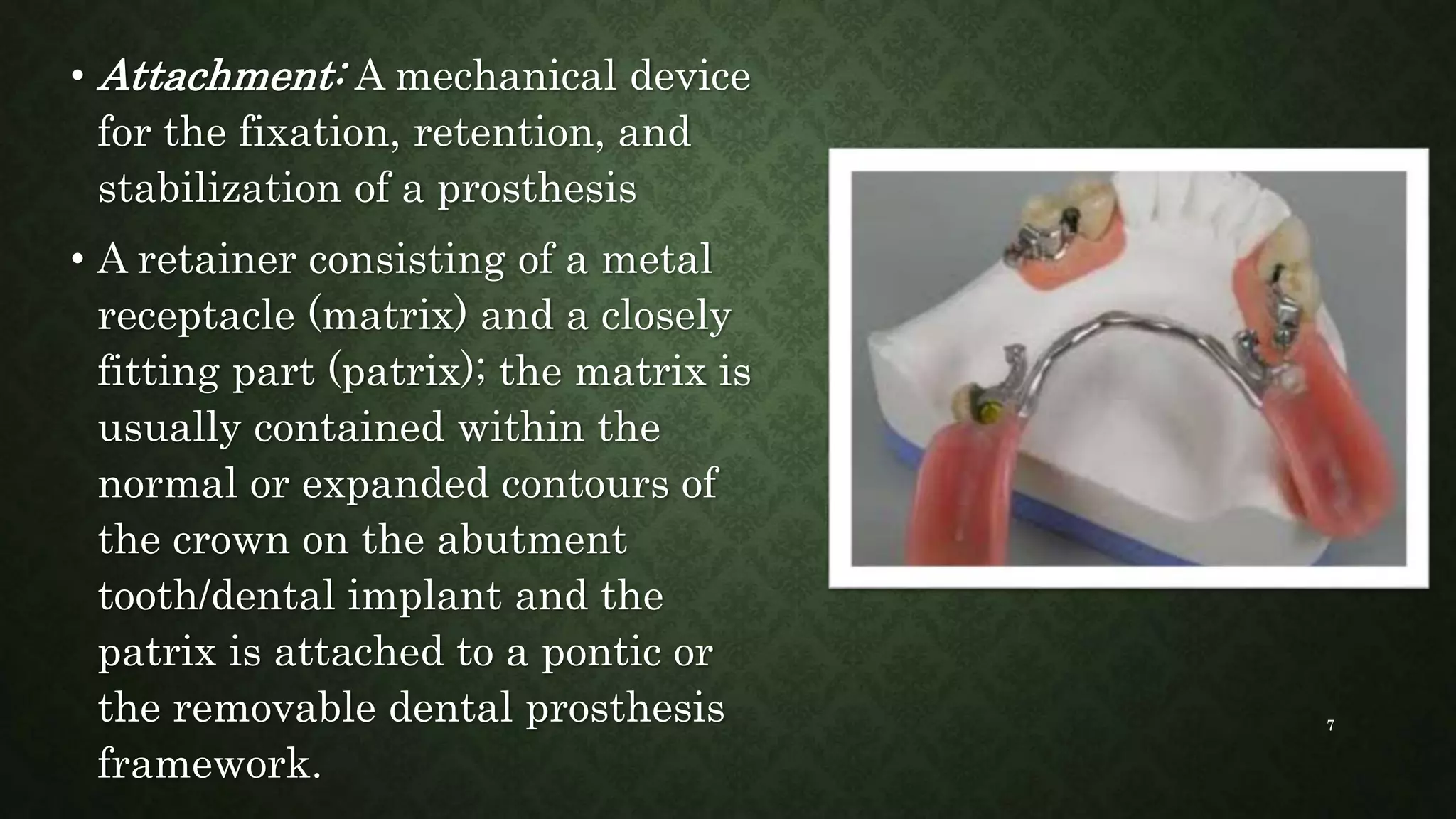 Kalpana stress breakers in rpd | PPTX