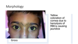 Types of anemia | PPTX