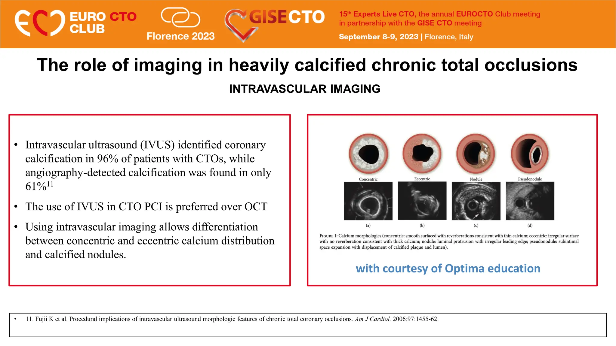 Kambis Mashayekhi: EuroCTO Consensus on treatment of Calcified CTO ...