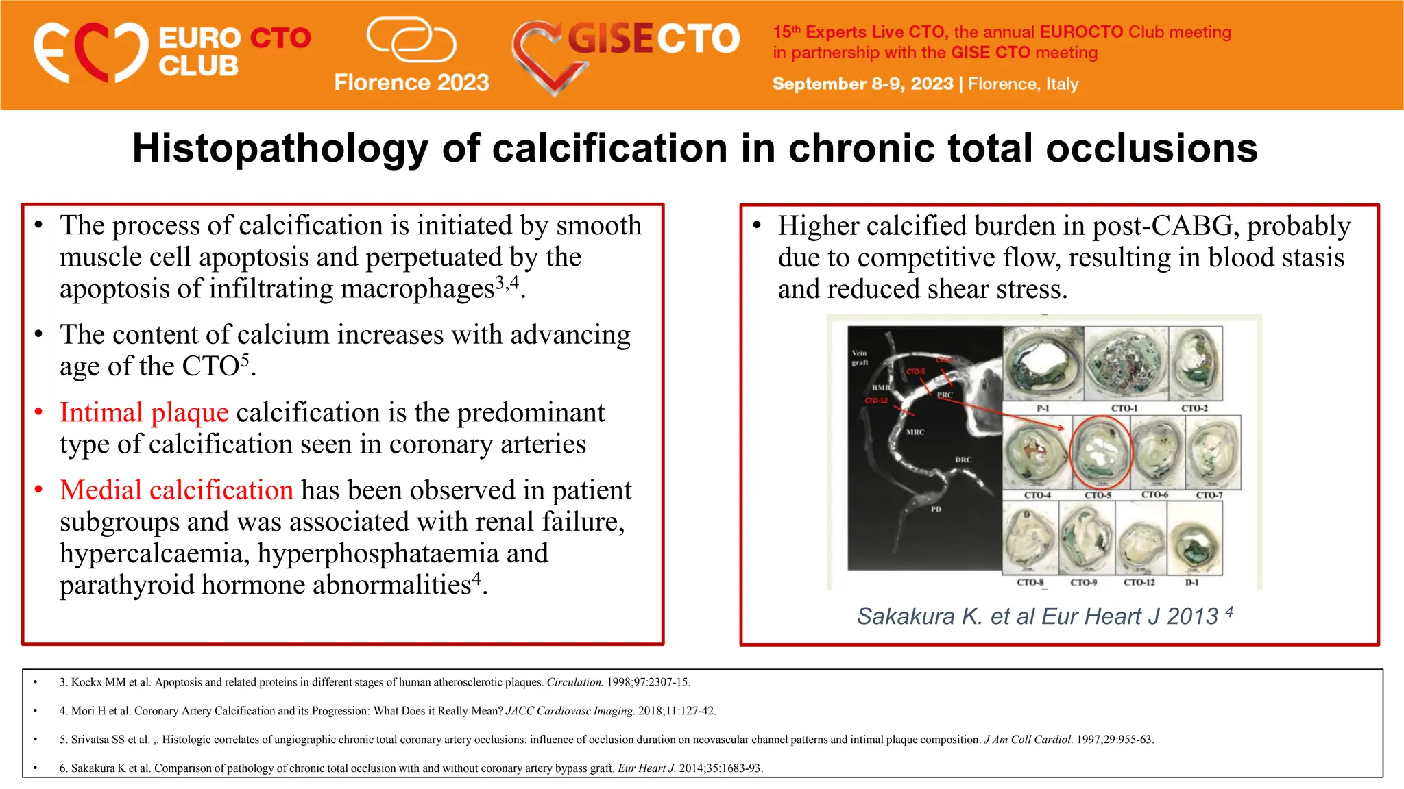 Kambis Mashayekhi: EuroCTO Consensus on treatment of Calcified CTO ...