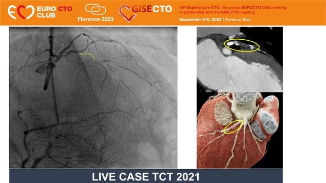 Kambis Mashayekhi: EuroCTO Consensus on treatment of Calcified CTO ...