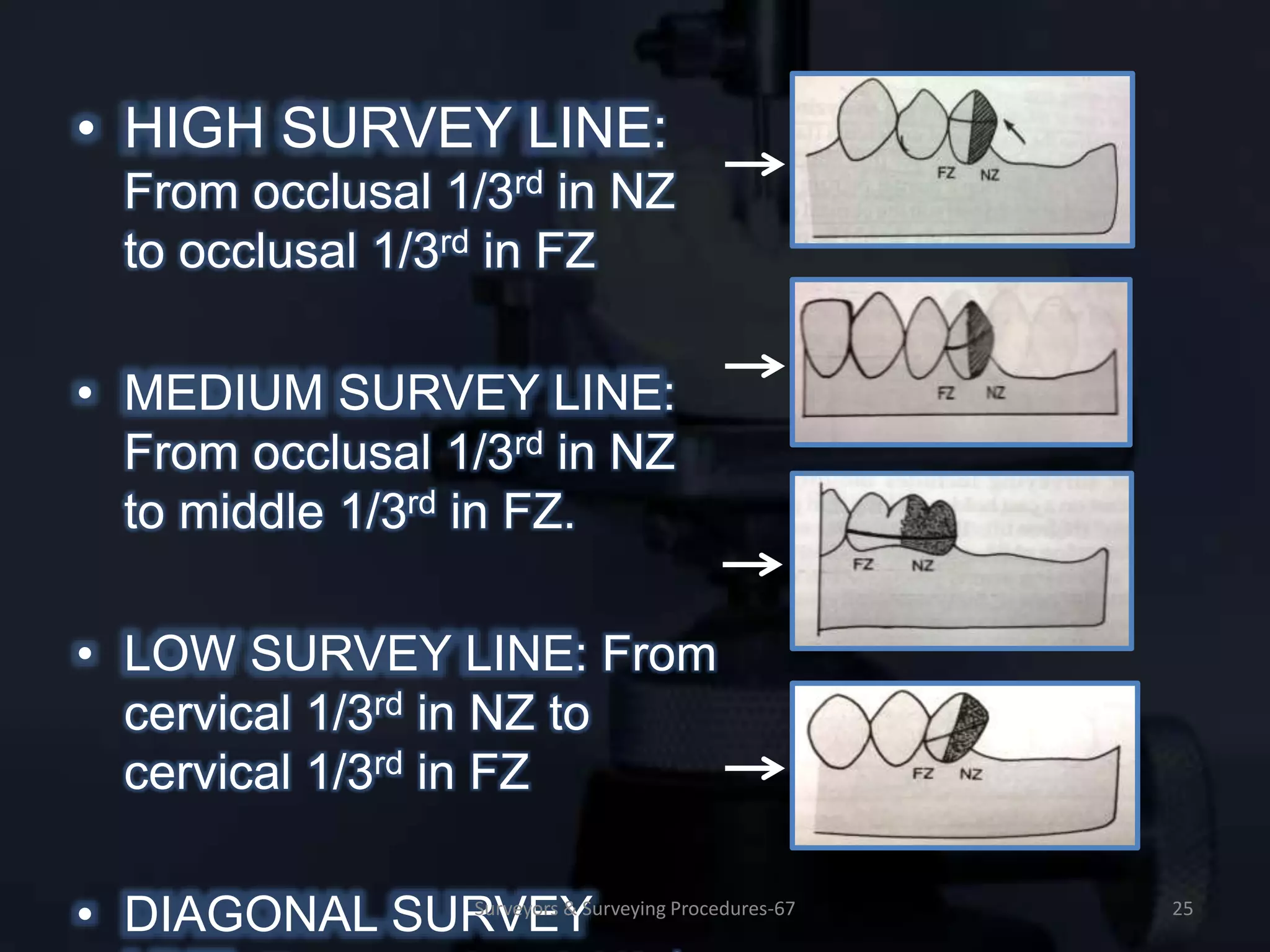SURVEYORS & SURVEYING PROCEDURES IN REMOVABLE PARTIAL PROSTHODONTICS | PPTX